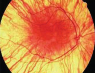 3g. Anterior Uvea — Developmental Irregularities